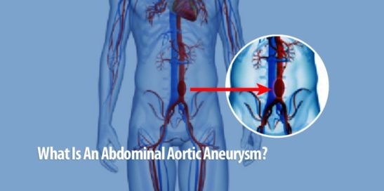 What Is An Abdominal Aortic Aneurysm?