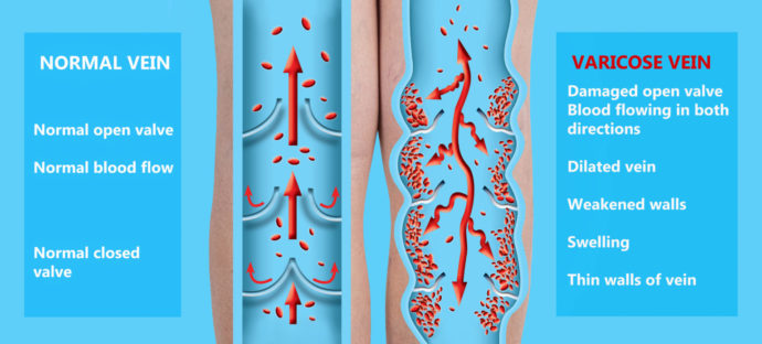 Varicose Veins - Symptoms & Treatments - Maryland Vascular Specialists